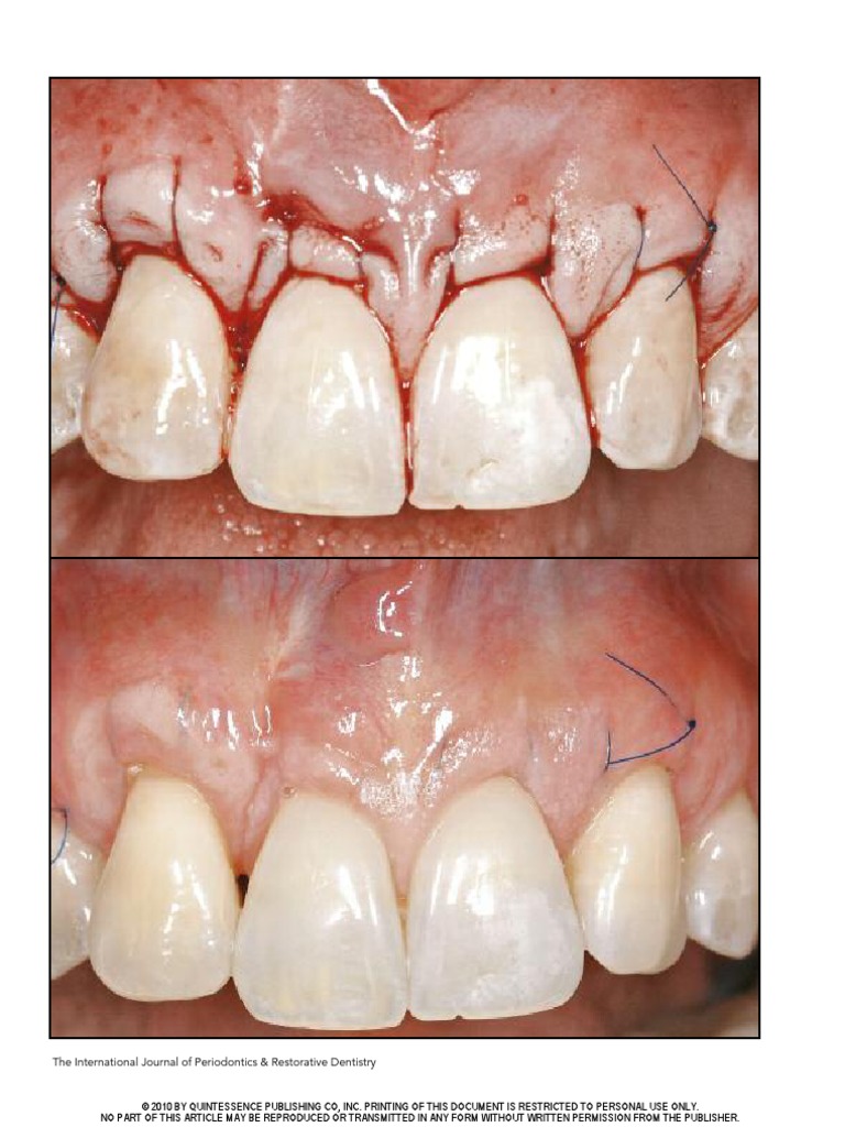 3 | PDF | Periodontology | Surgical Suture