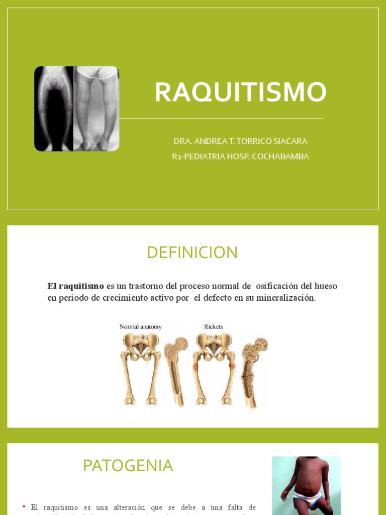 Raquitismo | PDF | Vitamina D | Hueso