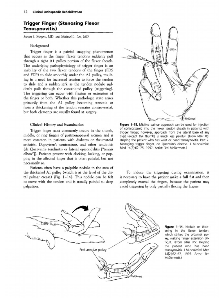 Trigger Finger-1 | PDF