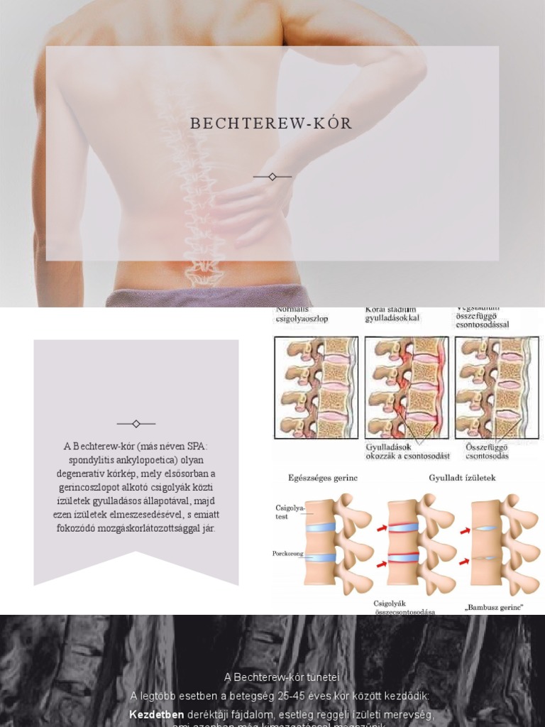 Bechterew-kór | PDF