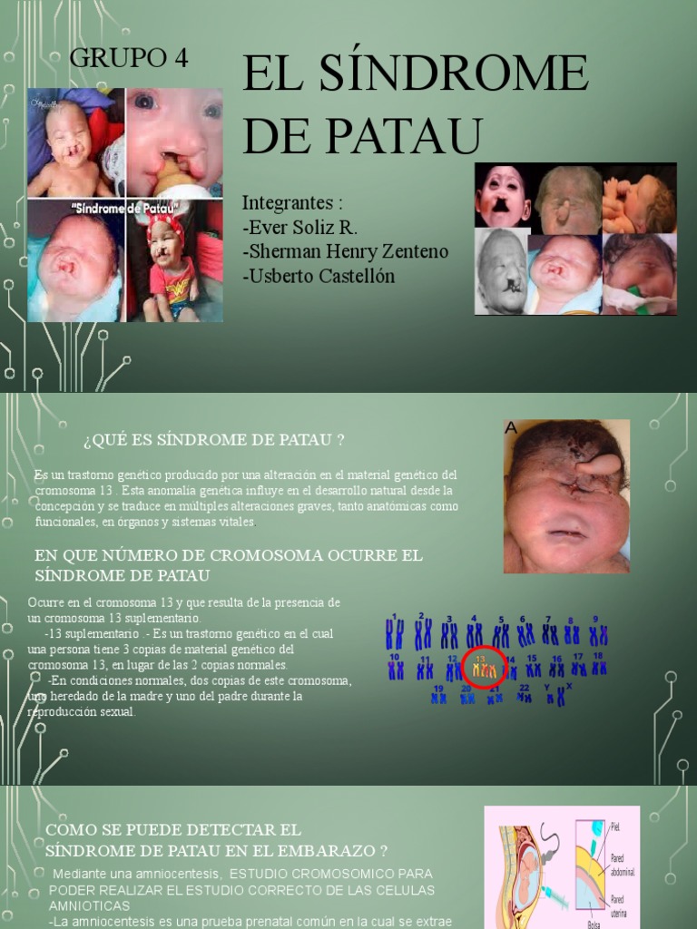 Grupo 4: El Síndrome de Patau | PDF | Enfermedades y trastornos ...