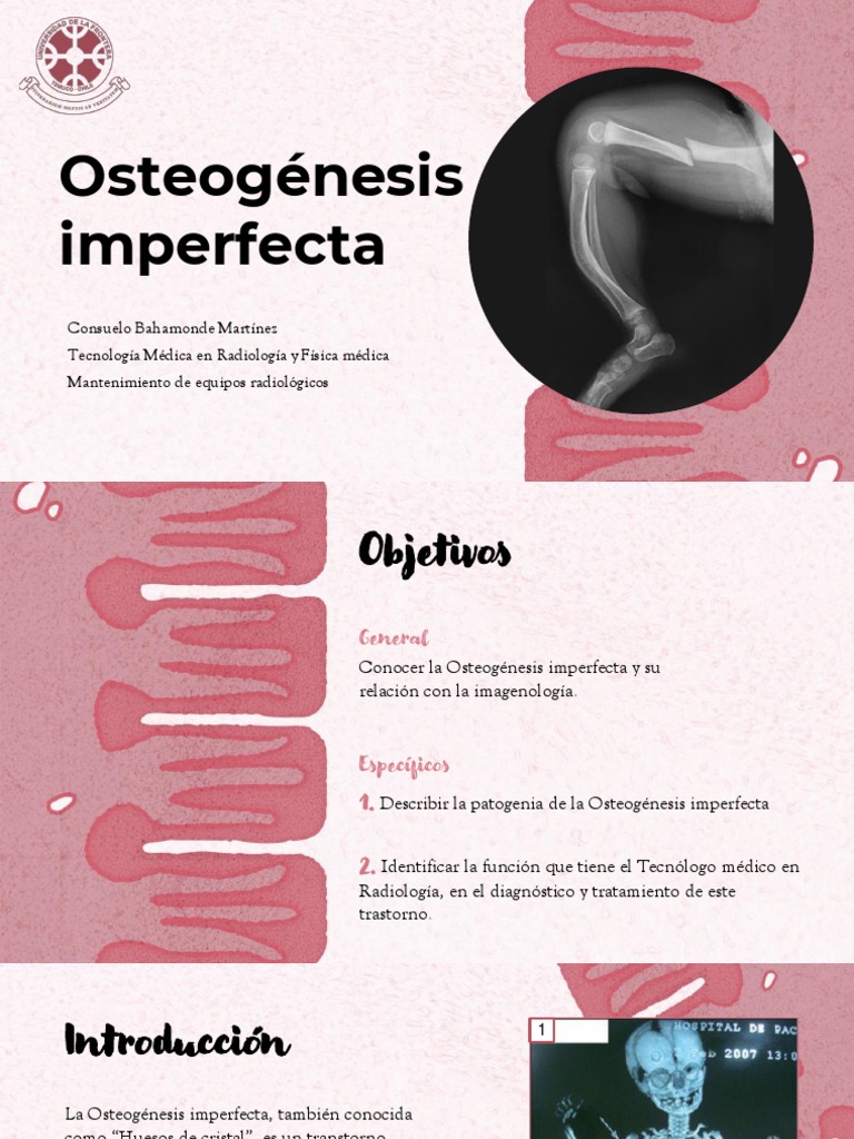 Osteogénesis Imperfecta y Radiología | PDF | Terapia física ...