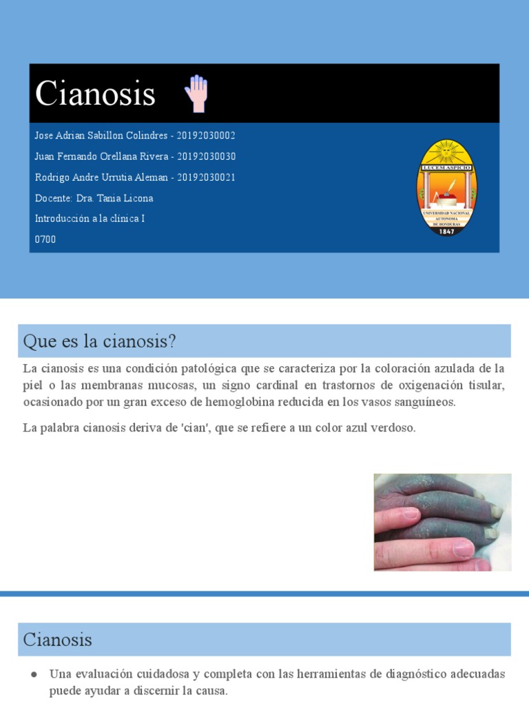 Cianosis: Una visión general de esta condición patológica caracterizada ...