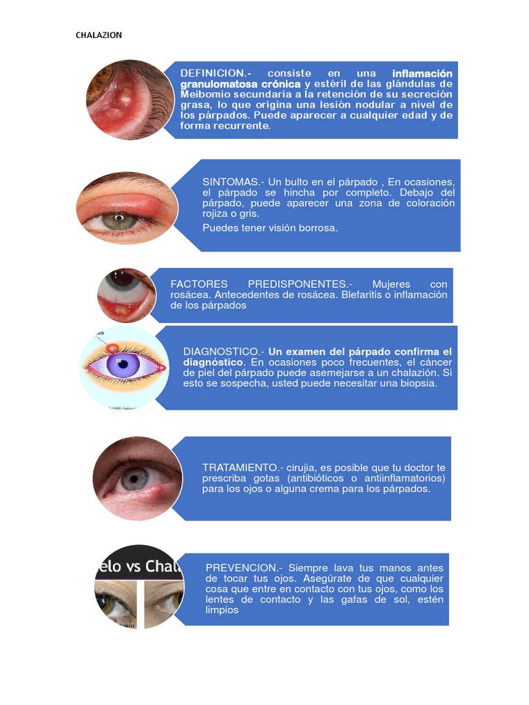 Chalazion 6 | PDF