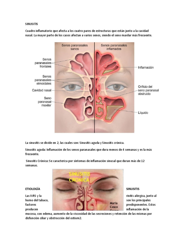 Análisis completo de la sinusitis: etiología, clasificación, diagnóstico, tratamiento y ...