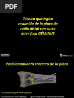 Técnica Quirúrgica Placa Philos: Conceptos | PDF | Tornillo | Metalurgia