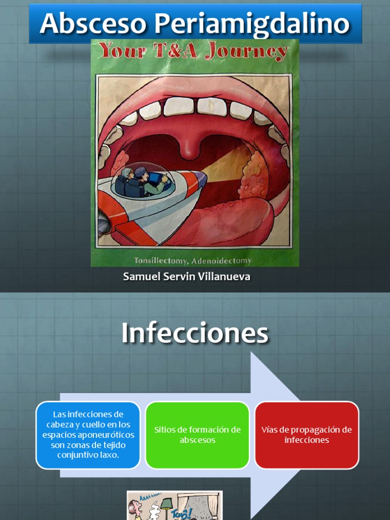 Absceso Periamigdalino | Penicilina | Antibióticos