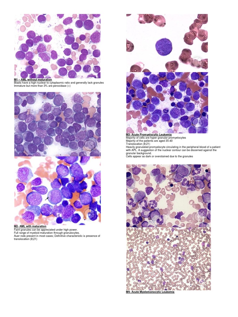 Fab Classification Of Acute Myelogenous Leukemia Aml Pdf Leukemia