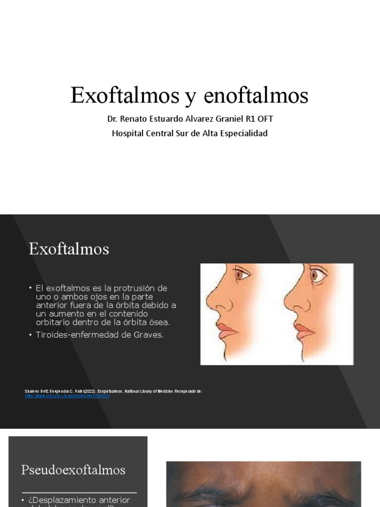 Exoftalmos y Enoftalmos | PDF
