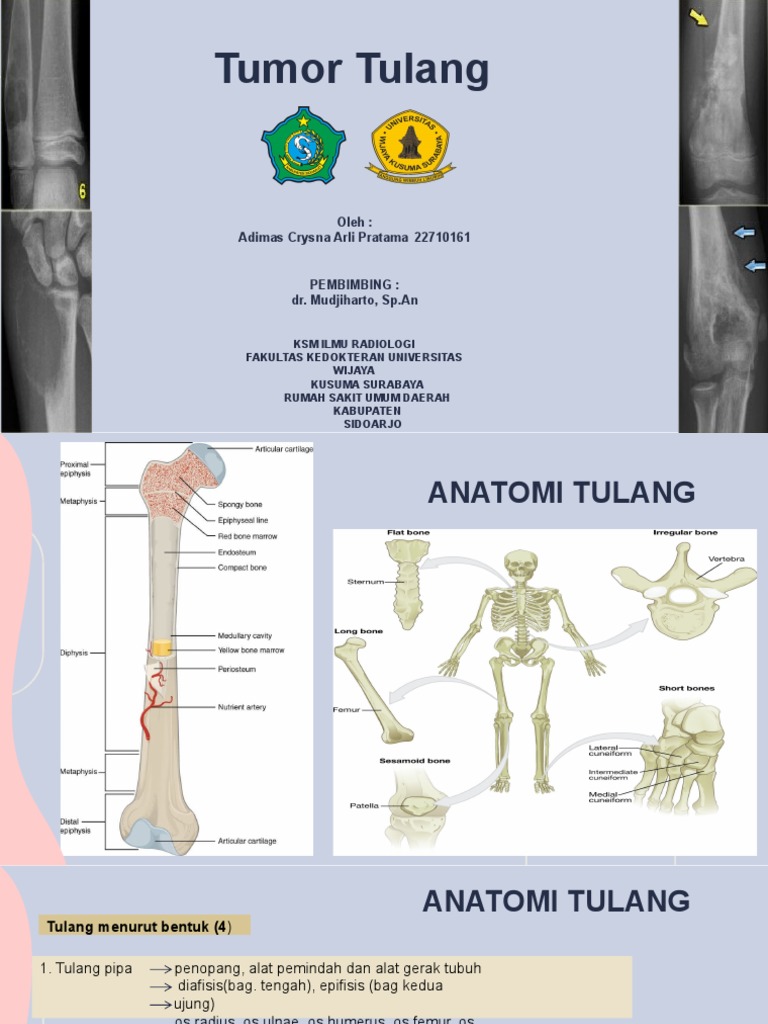 Tumor Tulang | PDF