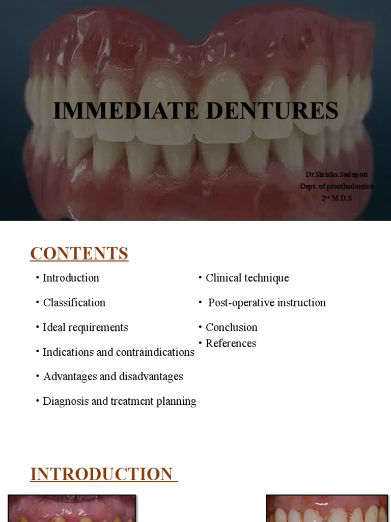 Classification and Types of Immediate Dentures Based on Flange Design ...
