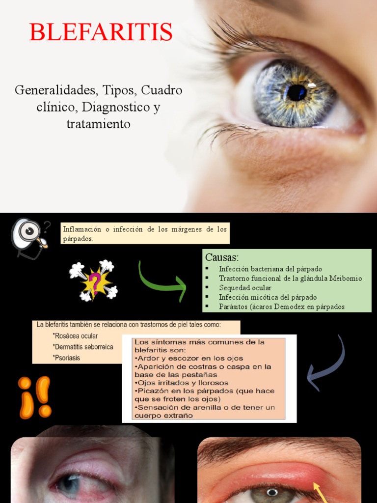 Blefaritis: Generalidades, Tipos, Cuadro Clínico, Diagnostico y ...