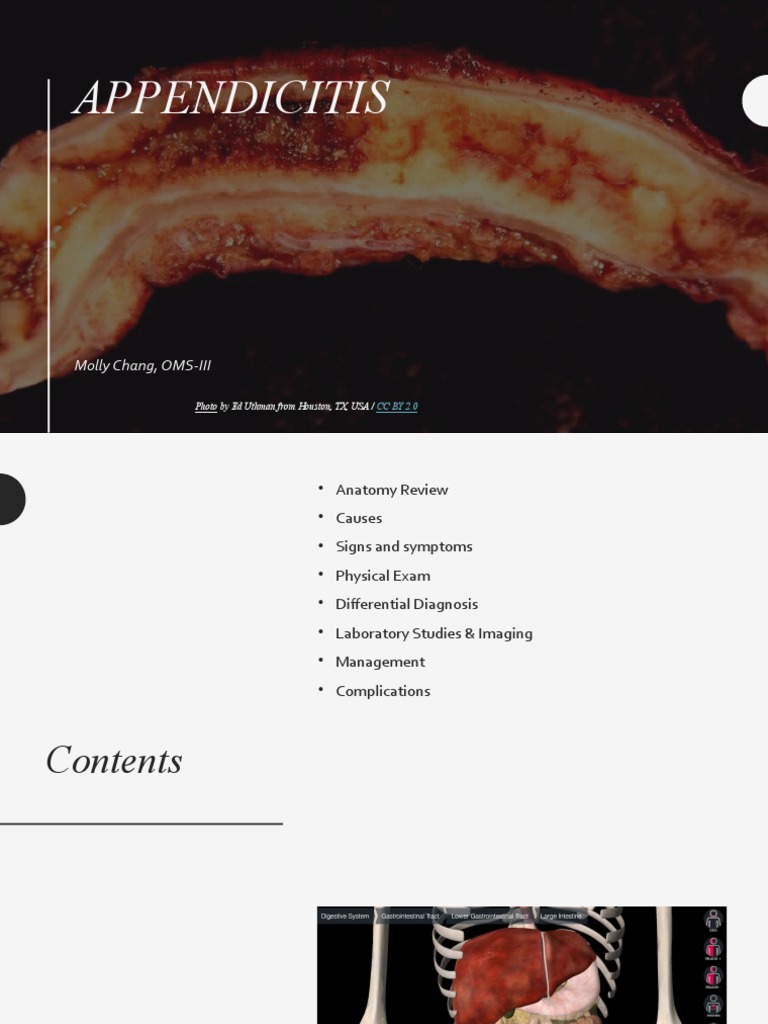 Appendicitis | PDF | Clinical Medicine | Health Sciences