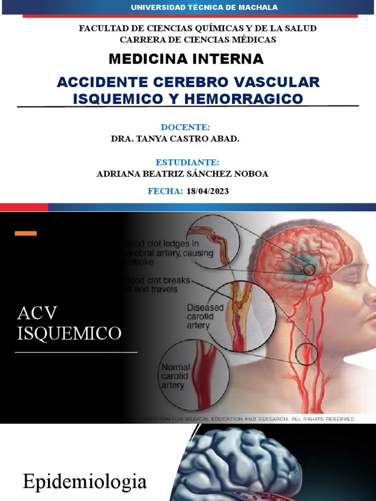 Acv Isquemico | PDF | Carrera | Especialidades Medicas