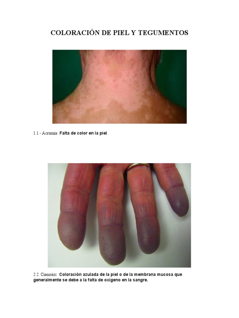 Coloración de Piel Y Tegumentos: 1.1.-Acromía | PDF | Piel ...