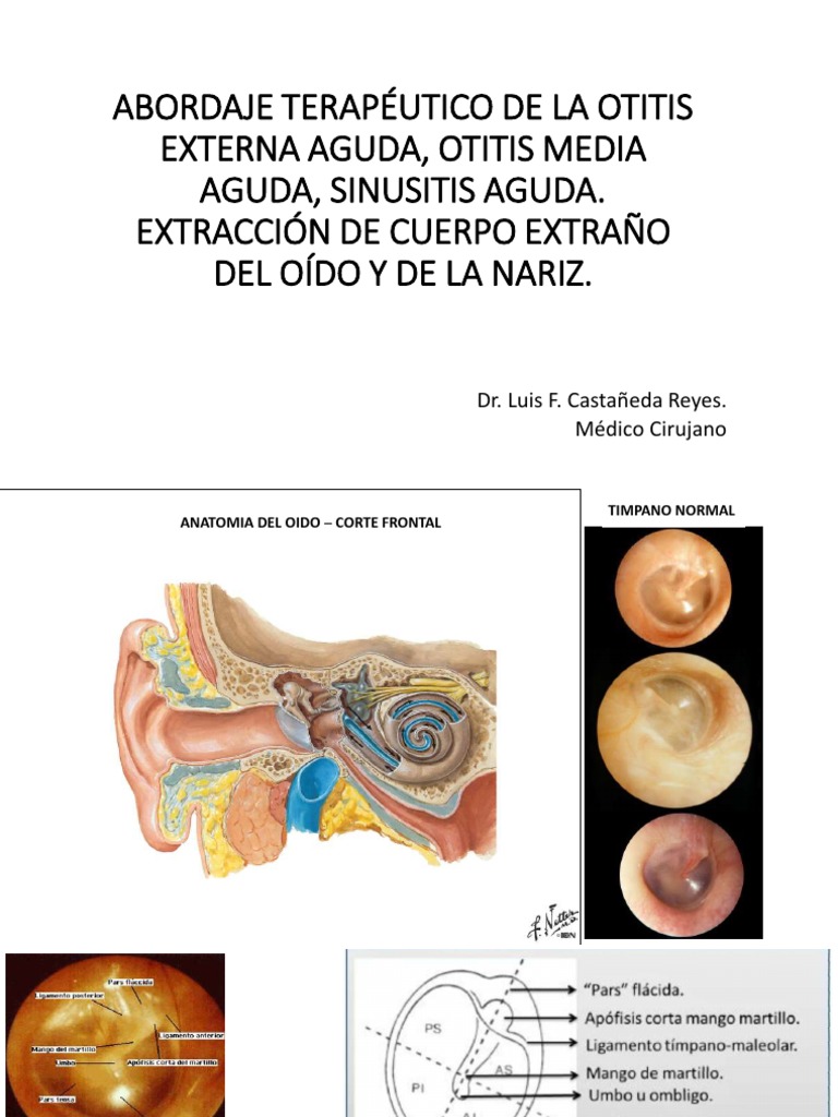 Abordaje Terapéutico de La Otitis Externa Aguda, Otitis Media Aguda ...