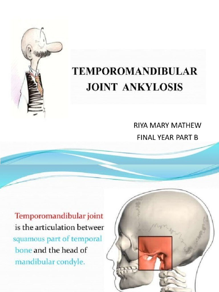 TMJ Ankylosis | PDF