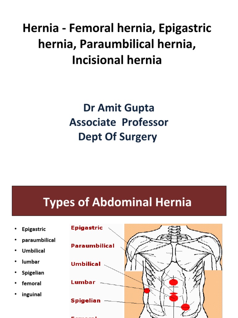 Hernia - Femoral Hernia, Epigastric Hernia, Paraumbilical Hernia ...