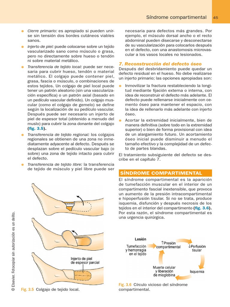 Síndrome Compartimental | PDF