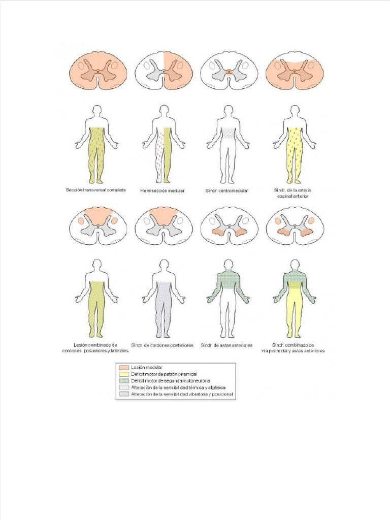 Shock Medular y Lesiones Completas | PDF | Neuroplasticidad | Neurona