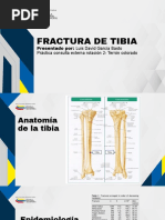 Fractur de Diafisis de La Tibia | PDF | Ct Scan | Hueso