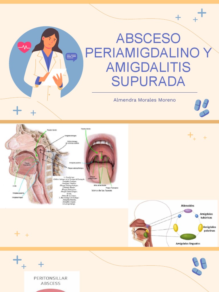 Absceso Periamigdalino