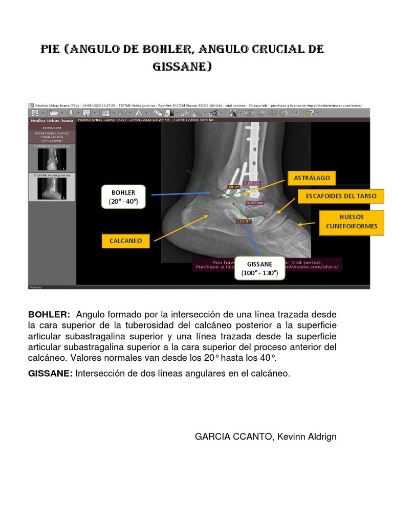 Angulos de Bohler y Gissane en Calcáneo | PDF