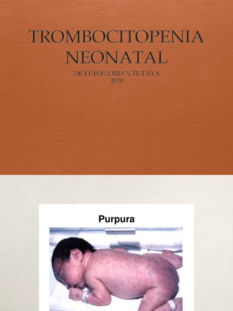 13 Trombocitopenia Neonatal | PDF | Parto prematuro | Plaqueta 13 Trombocitopenia Neonatal | PDF | Parto prematuro | Plaqueta