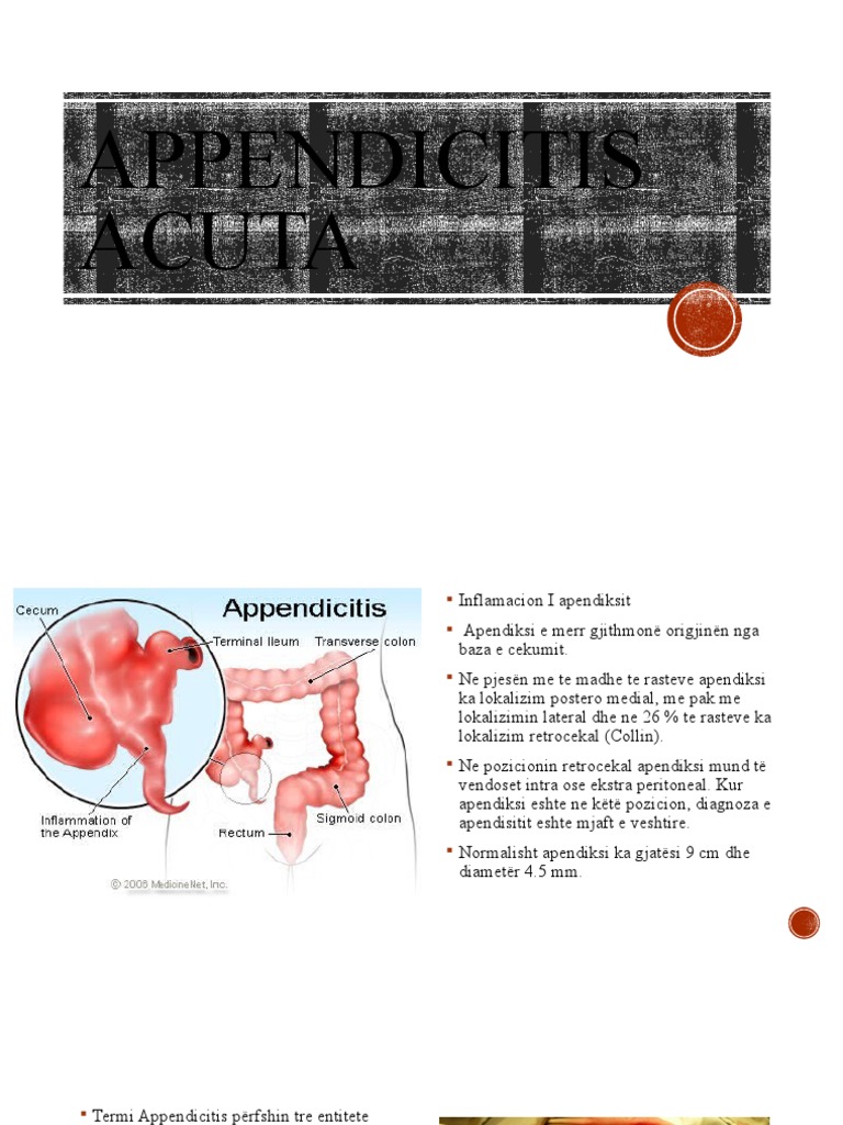 Appendicitis Acuta | PDF