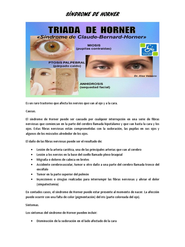 Características clínicas y causas del síndrome de Horner | PDF | Ojo ...