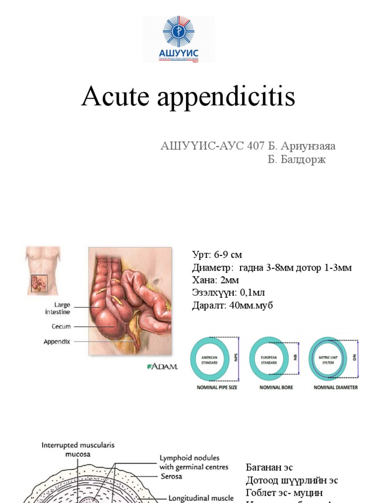 Acute Appendicitis | PDF