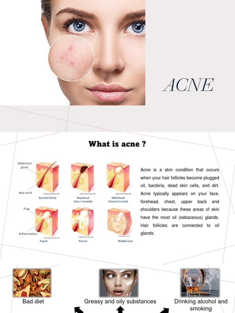 Acne (ENG) PDF | PDF