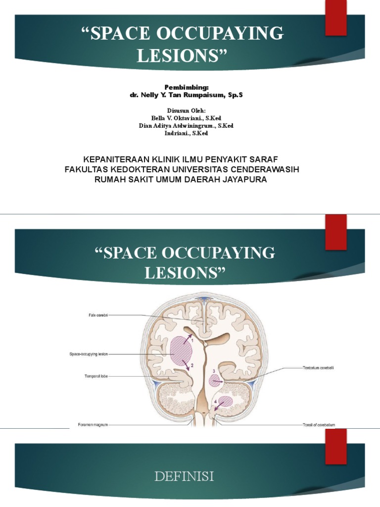 ppt refarat SOL.pptx | PDF