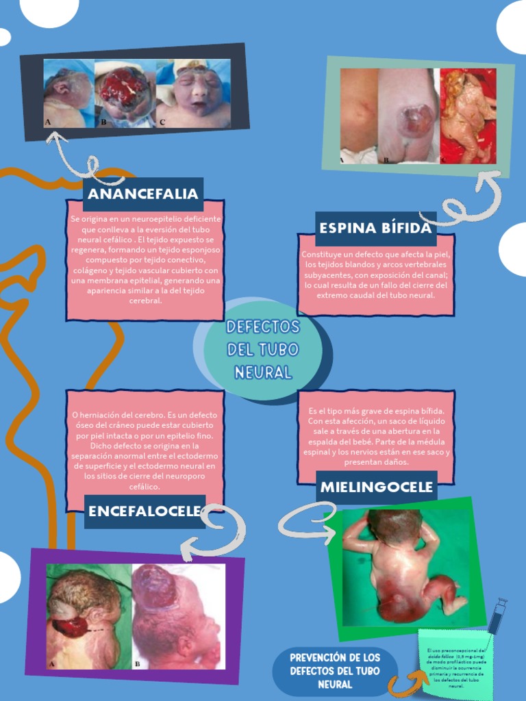 Infografía de Defectos Del Tubo Neural | PDF