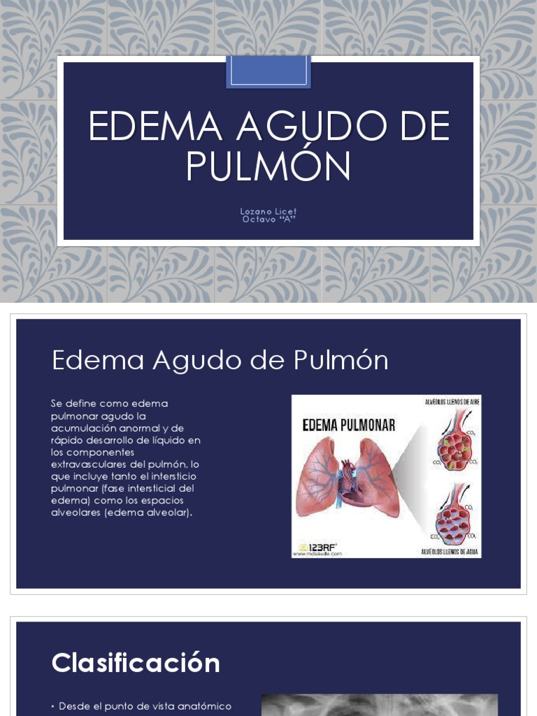 Edema Agudo de Pulmón PDF | PDF