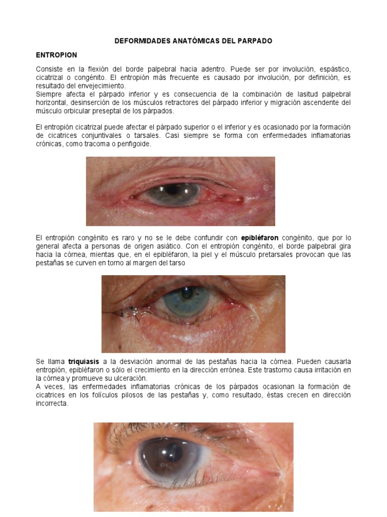 Deformidades Anatómicas Del Parpado | PDF | Cirugía | Ojo humano