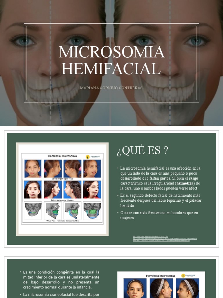 Microsomia Hemifacial | PDF | Epidemiología | Medicina