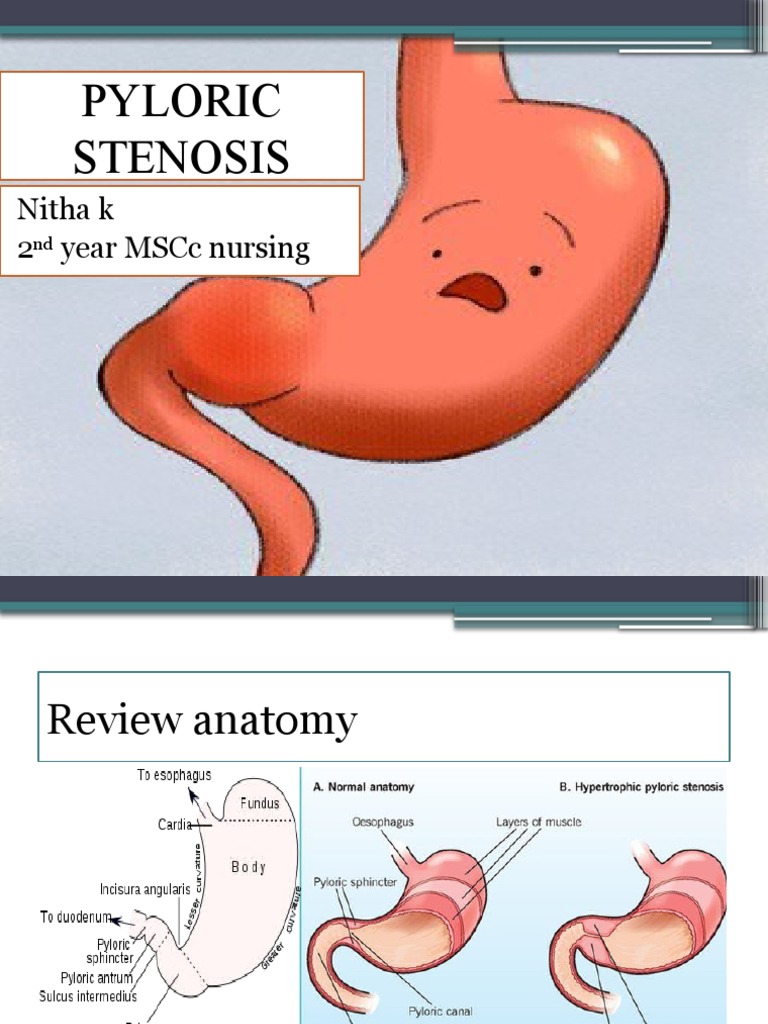Pyloric Stenosis Original | PDF