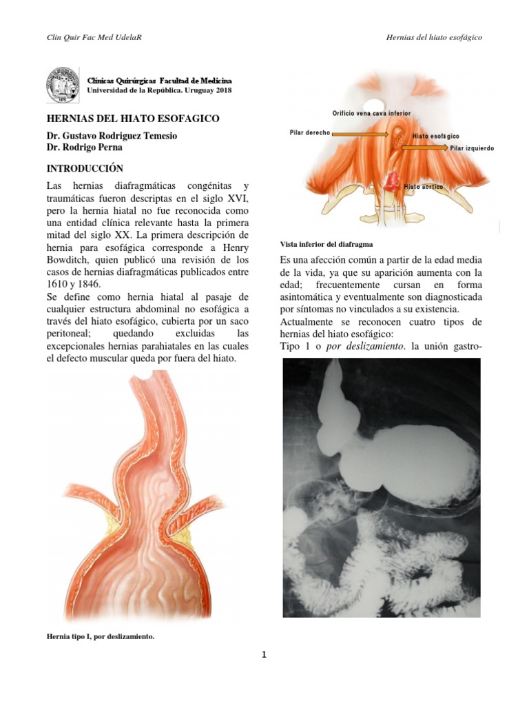 Hernias Del Hiato Esofágico CQFM | PDF | La enfermedad por reflujo ...