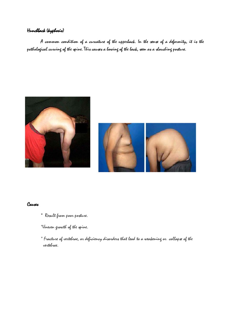 Understanding Postural Disorders: Kyphosis, Knock-Knees, and Bow ...