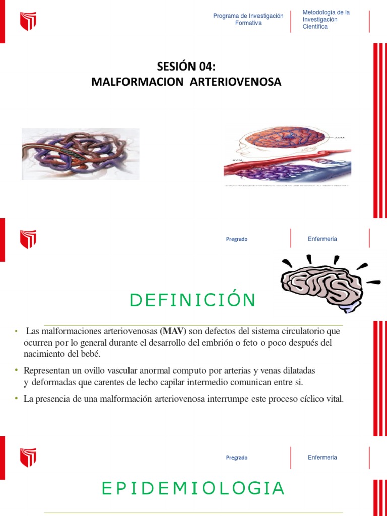 Malformación Arteriovenosa PDF | PDF