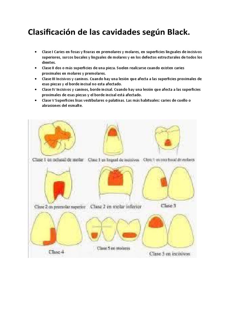 Clasificación de Cavidades según Black | PDF
