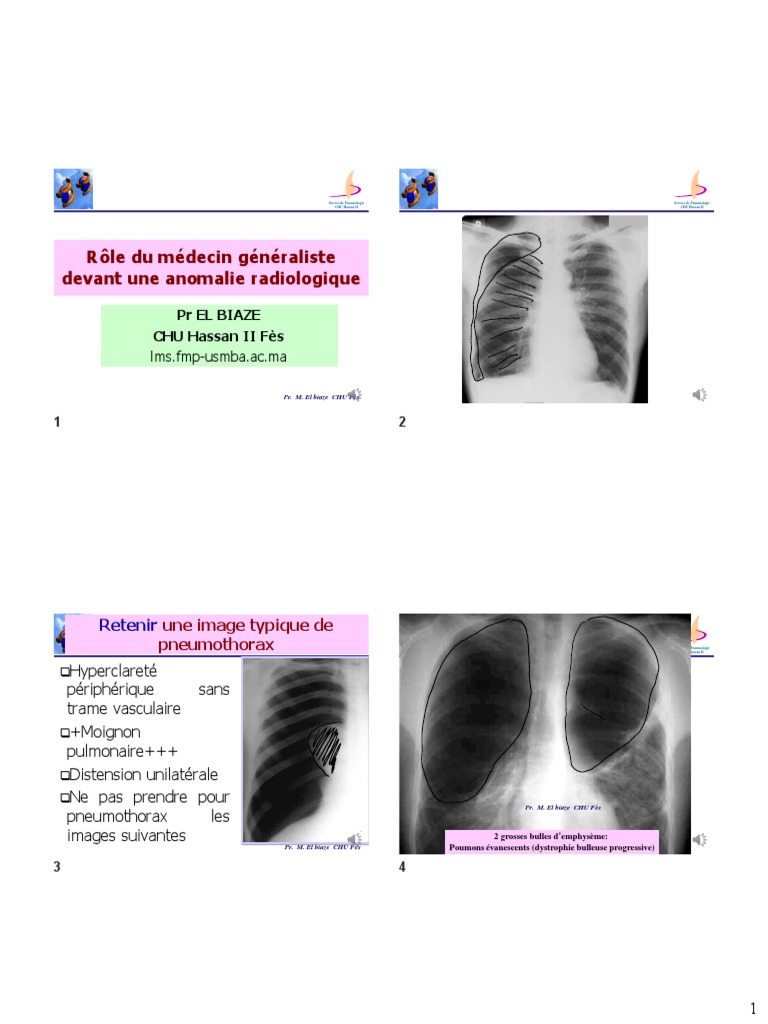 Pneumothorax : Diagnostic et Traitement | PDF
