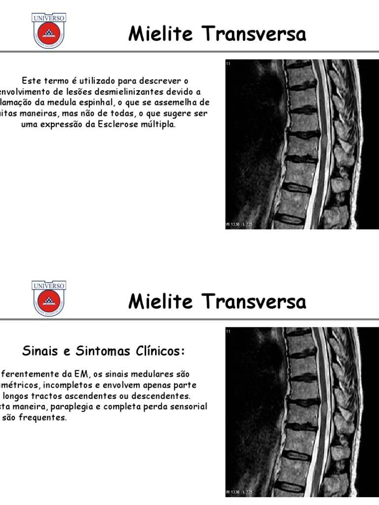 Sintomas e Tratamento da Mielite Transversa | PDF | Especialidades ...