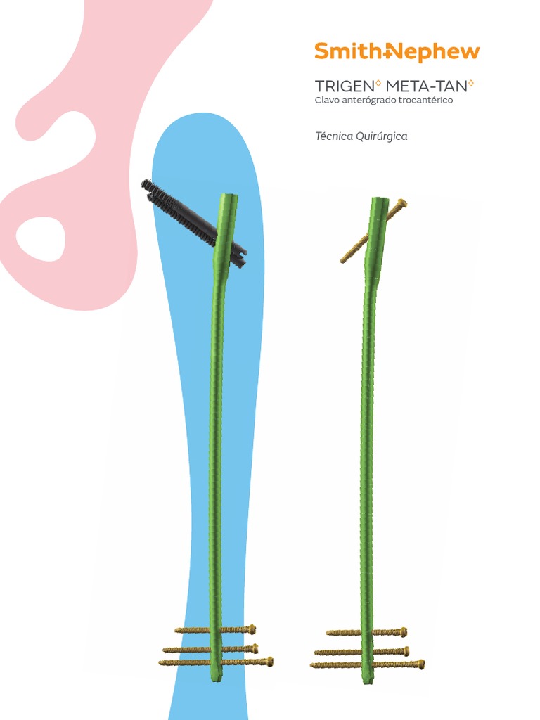 TRIGEN METATAN TQ clavo anterogrado trocanterico | PDF