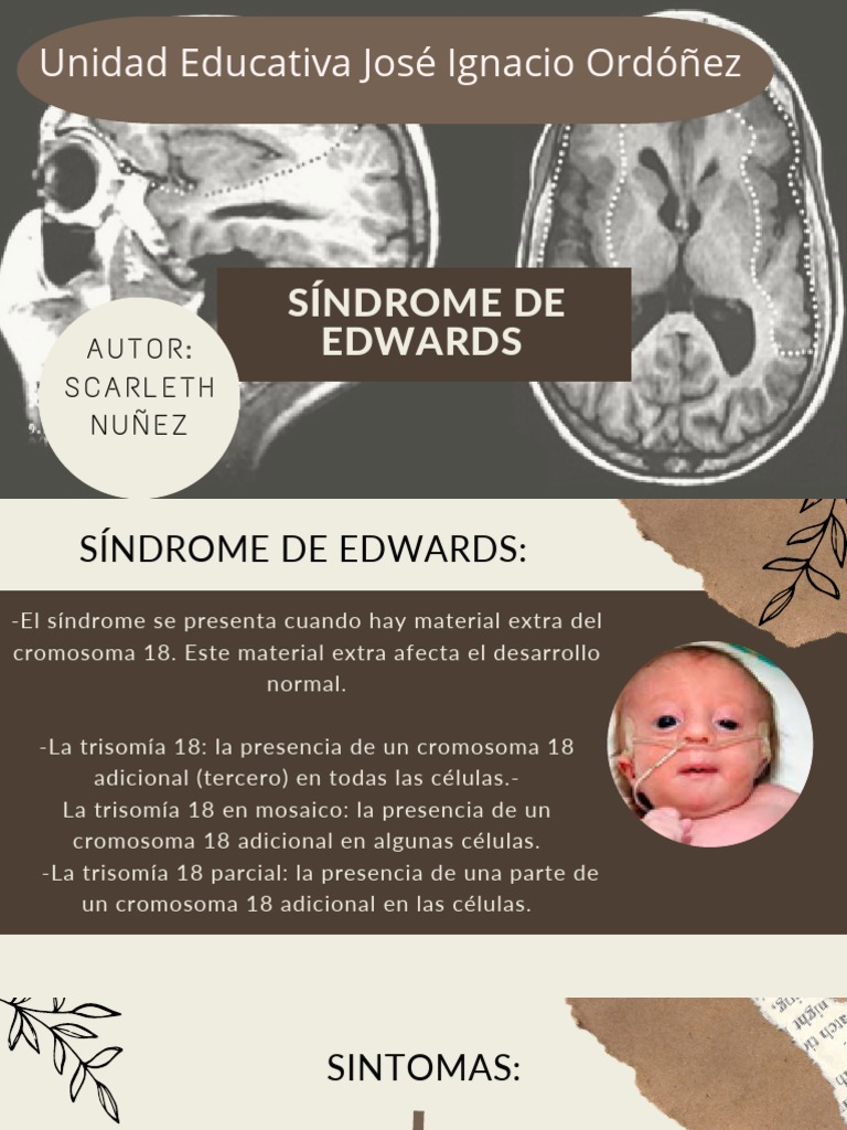 Sindrome de Edwards | PDF