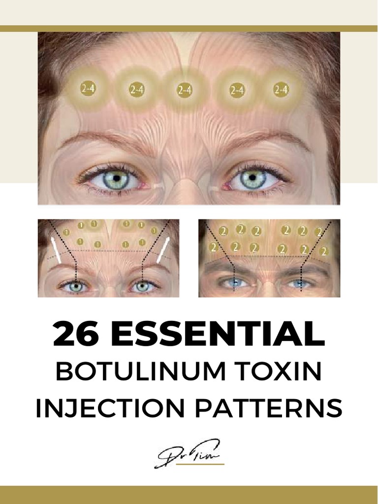 26-Essential-Botulinum-Toxin-Injection-Patterns | PDF | Botulinum Toxin | Eyebrow