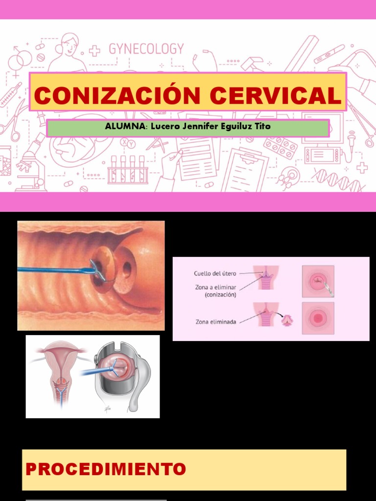 Conización Cervical Con Asa | PDF