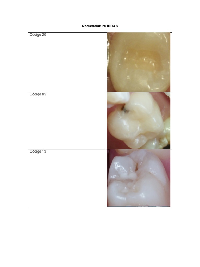 Nomenclatura ICDAS | PDF