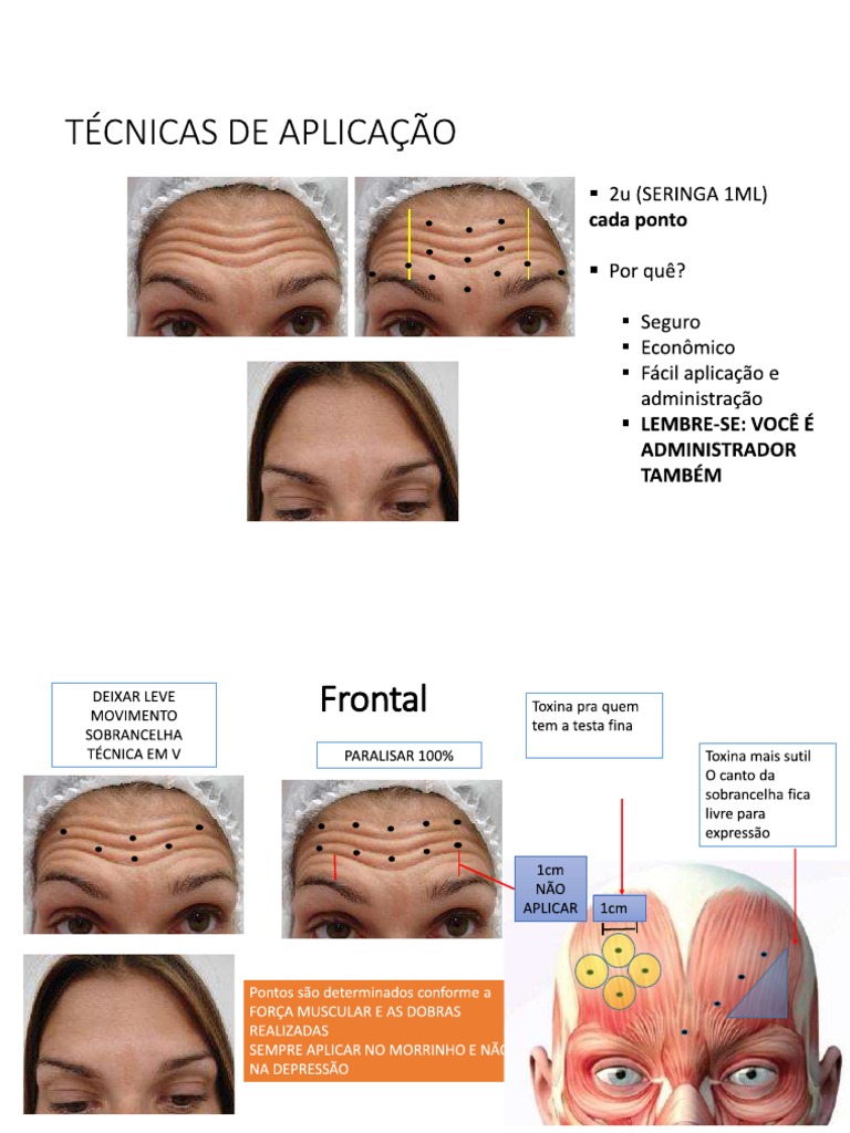 Tecnica de Aplicaçao de Toxina Botulinica | PDF